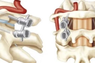 Dr. Nikhil Malewar - Best Spine Surgeon in Nagpur, Spine Specialist in ...