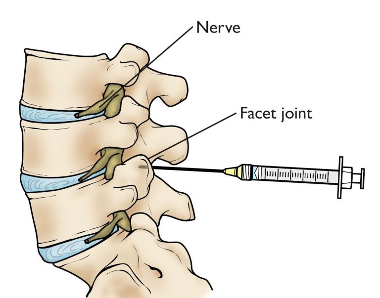 Spinal Injections - Dr. Nikhil Malewar