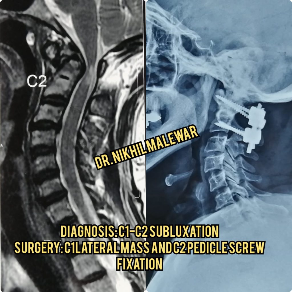 C1-C2 Fusion - Dr. Nikhil Malewar