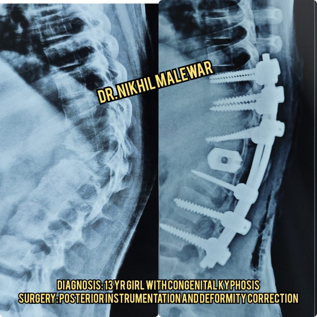 Scoliosis and Kyphosis Surgery - Dr. Nikhil Malewar
