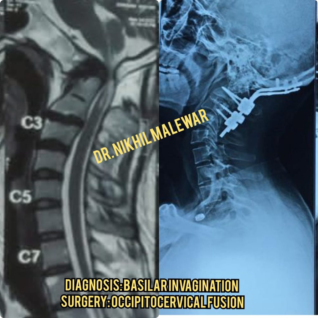 Occipitocervical Fusion - Dr. Nikhil Malewar